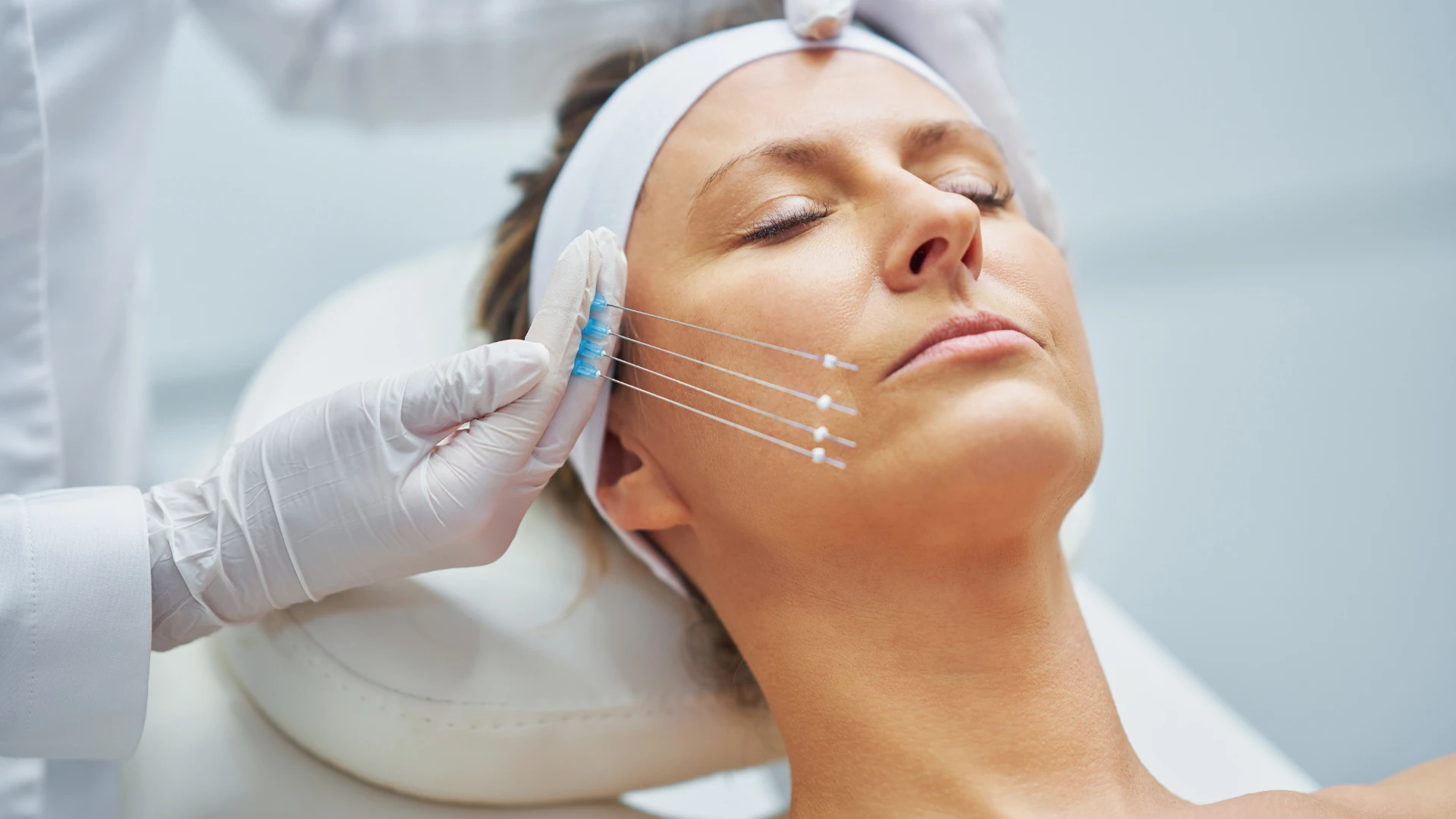 Thread Lift Treatments Archives Amplecare